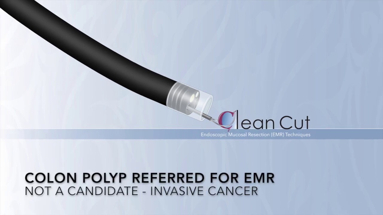 Colonoscopy: Colon polyp with invasive cancer not a candidate for EMR ...