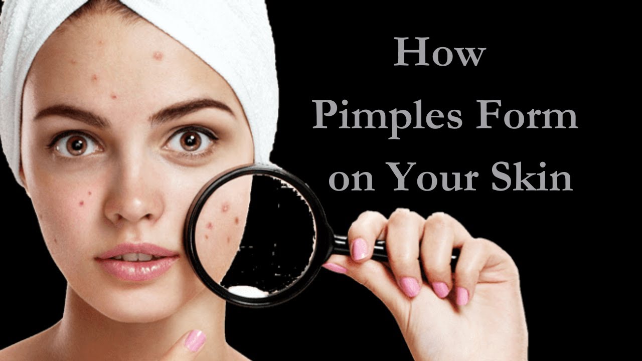 How Pimples Form on Your Skin by urks - YouTube