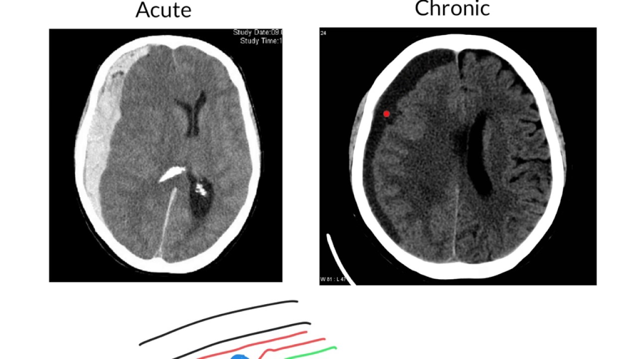 Subdural haemorrhage - YouTube