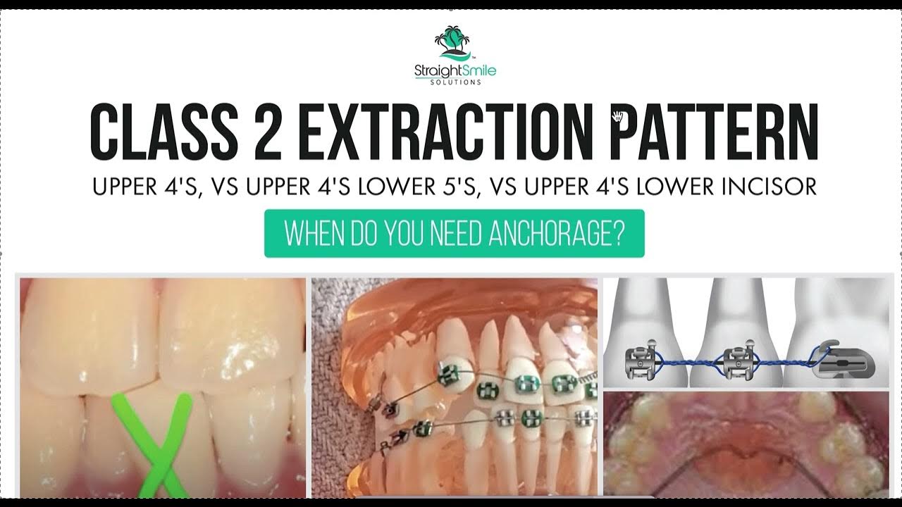 Class 2 Extraction Patterns: Upper 4's, Upper 4's lower incisor, Upper ...