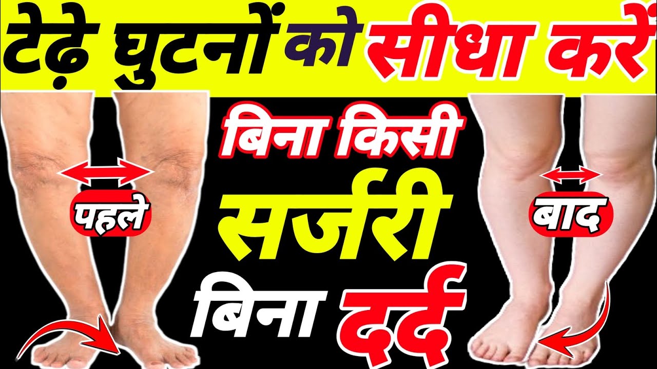 टेढ़े घुटनों को कैसे सीधा करें Bowed Legs|टेढ़े घुटनों का इलाज Genu ...