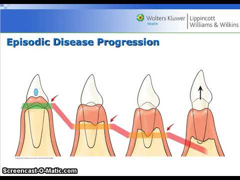 Disease Progression of Aggressive Periodontitis - Perio Ch 16 Lect I ...