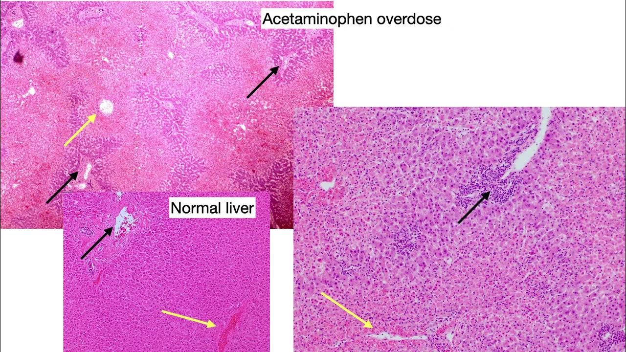 Liver Gallbladder Pancreas-Liver Failure and Cirrhosis Lect 1 - YouTube