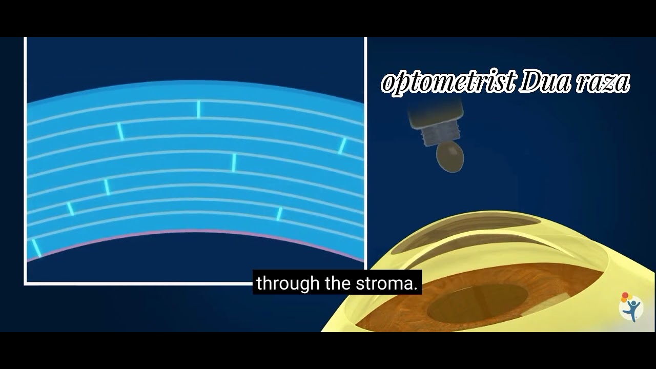 cxl procedure for keratoconus patient cornea ko mazboot krny ka tareeqa ...