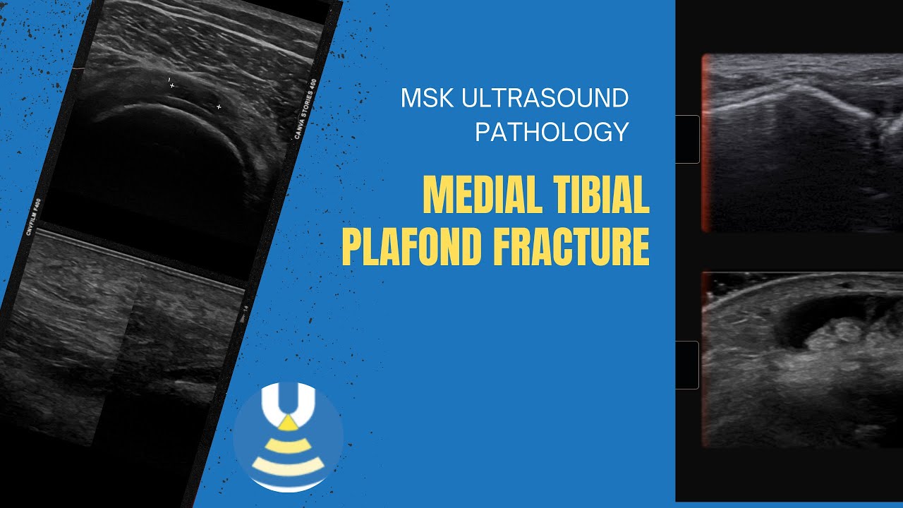 Medial tibial plafond fracture - YouTube