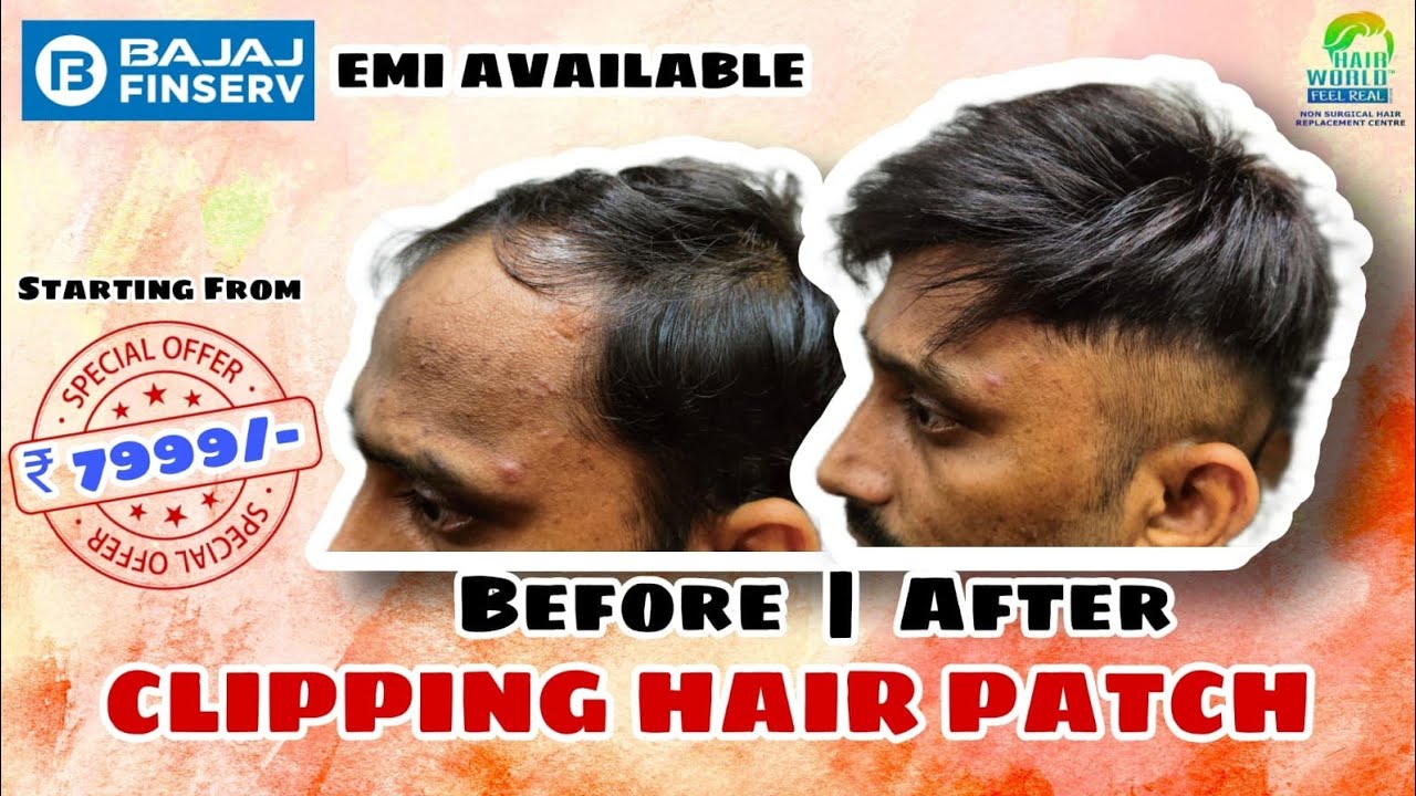 Hair Fixing For Men | Hair Wigs For Men | Hair Patch | Hair System ...