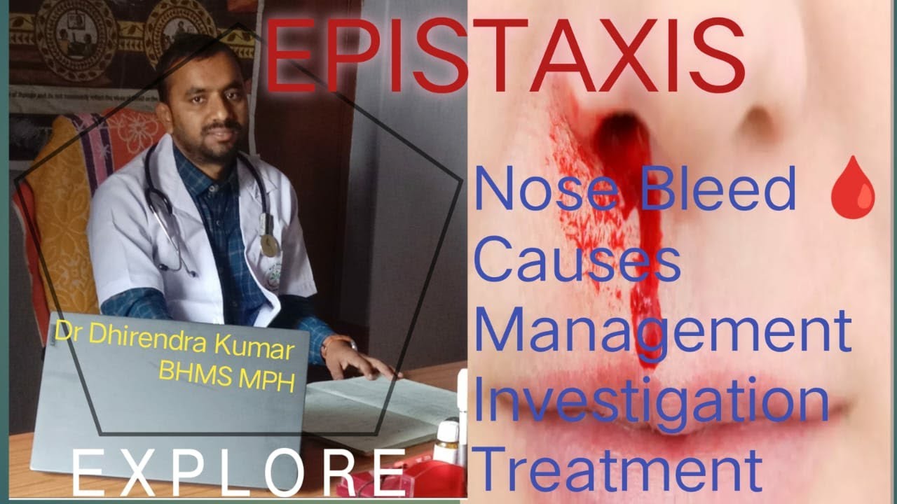 Epistaxis Nose Bleed causes management investigation treatment - YouTube