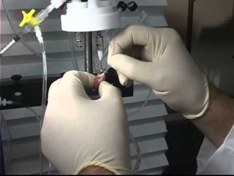 Balloon Insertion - YouTube