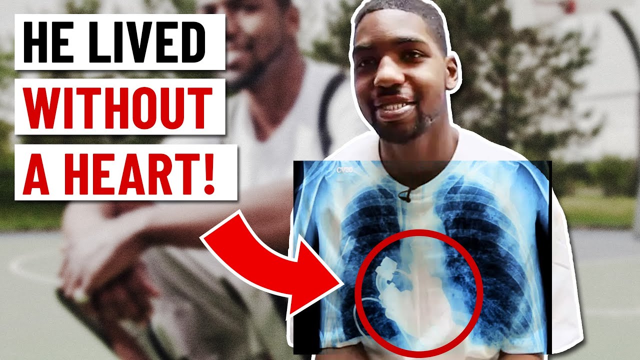 How this man lived WITHOUT A HEART for 555 days?! - YouTube
