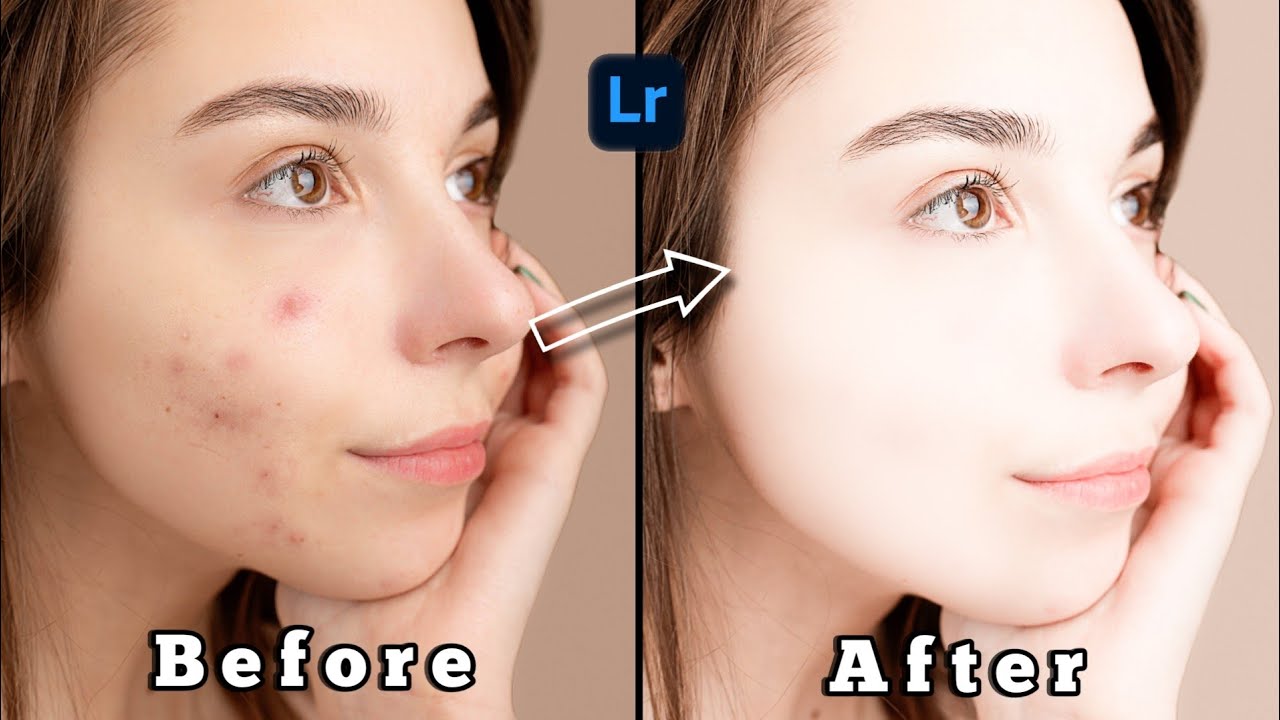 Face Retouching|Pimples Remove in Lightroom|With Just One Tool 🔥 ...