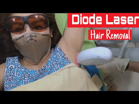 DIODE LASER UNDERARM HAIR REMOVAL @ GLUTAPEEL l SATISFYING RESULTl ...