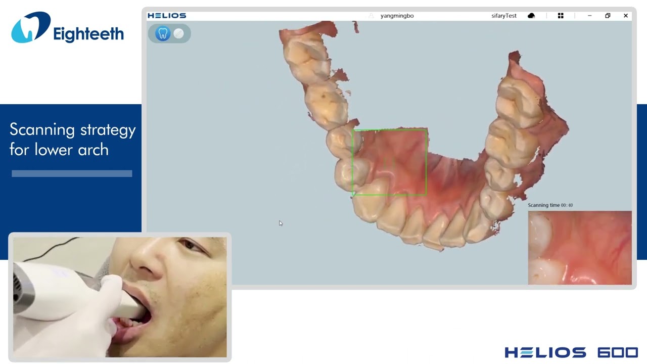 Eighteeth Helios 600 Intraoral Scanner Scanning Strategy for Lower Arch ...