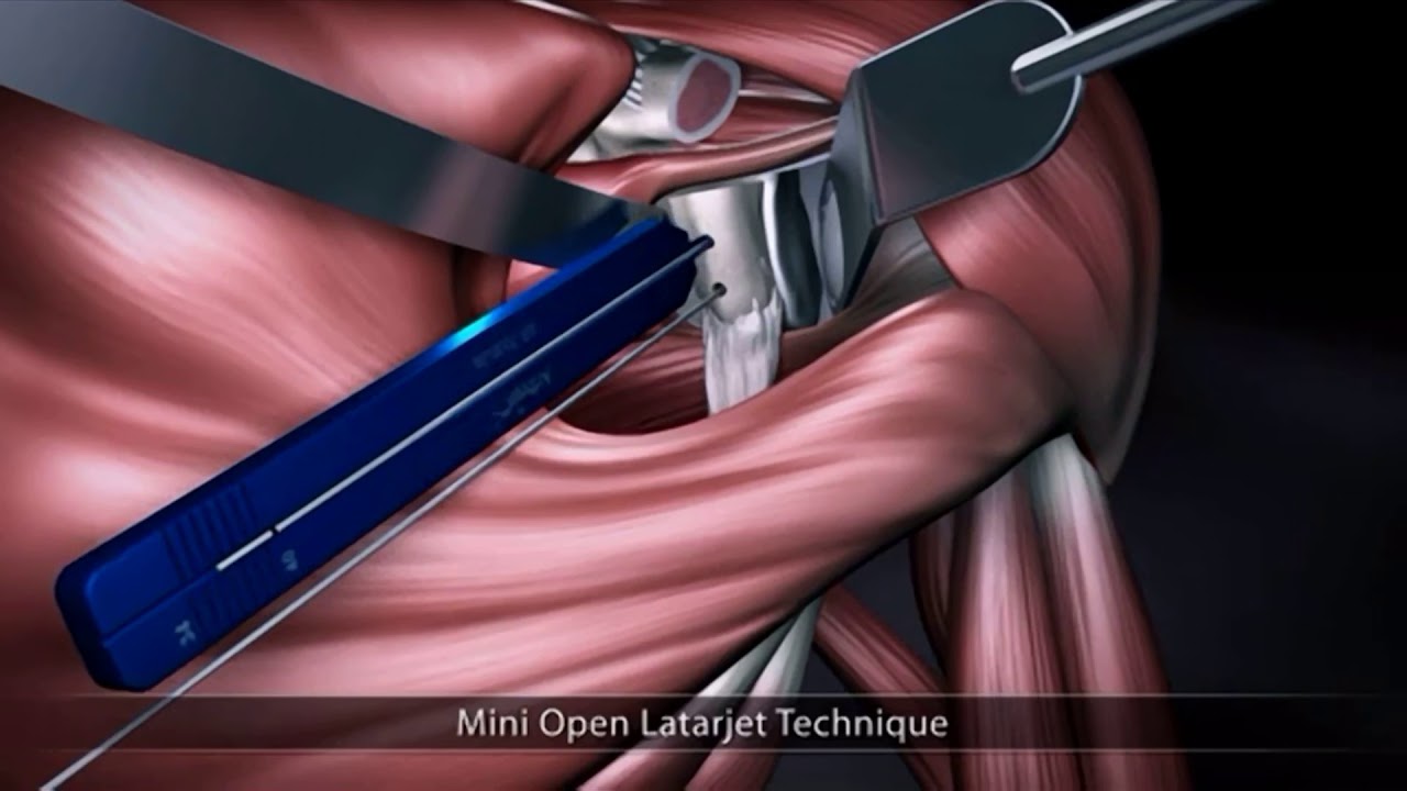 Luxation Gléno-Humérale récidivante - YouTube