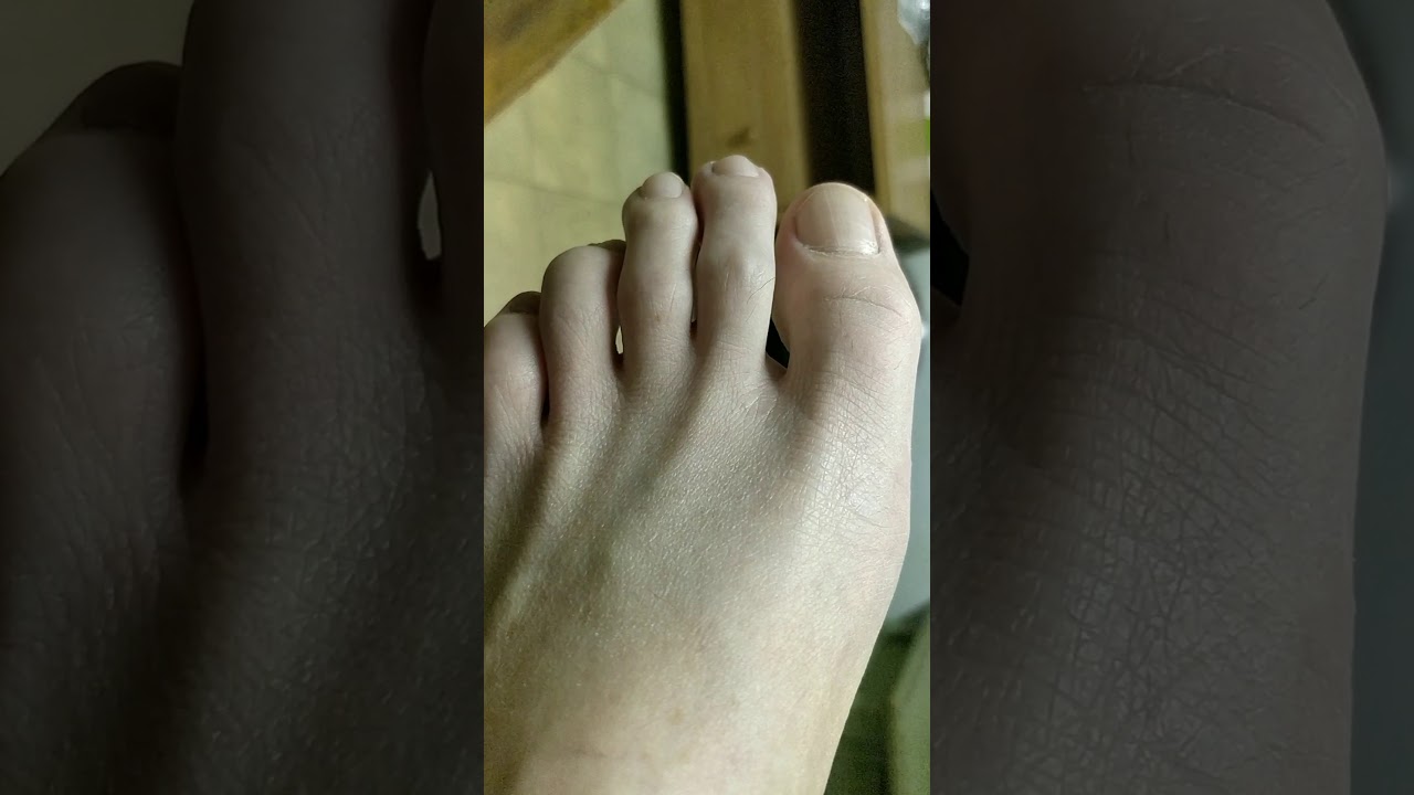 Cramp Fasciculation Syndrome symptom, toes twitching - YouTube