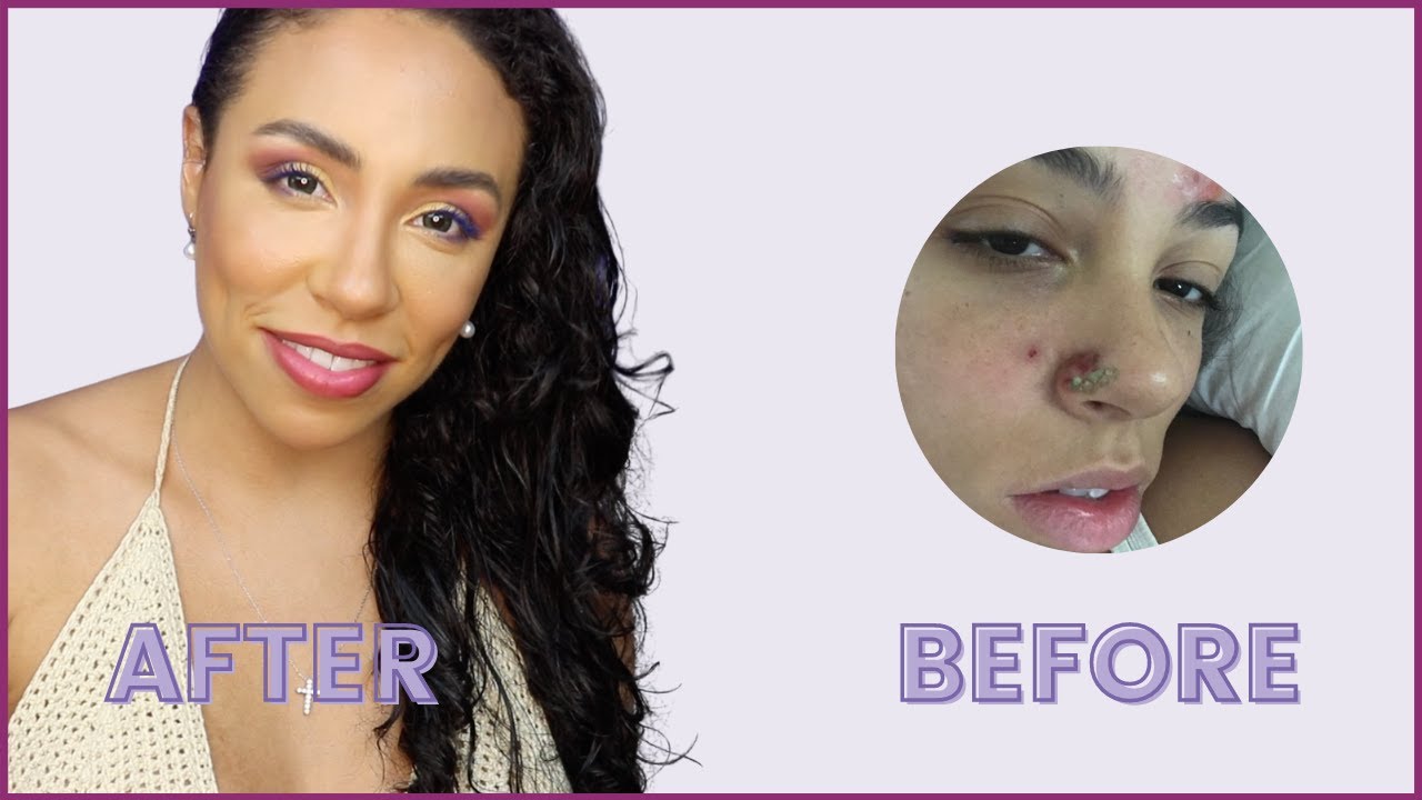 ACNE, BOILS + SKIN PROBLEMS | what actually works - YouTube