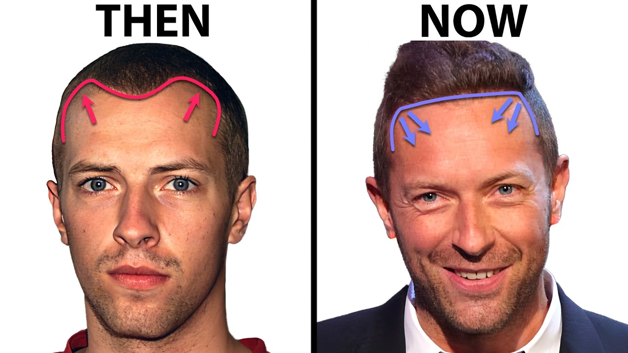 Chris Martin's Hair Transplant (Coldplay) | Plastic Surgery Analysis ...