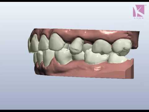 Protraction of Upper Anterior Teeth to Reduce Wrinkles - YouTube