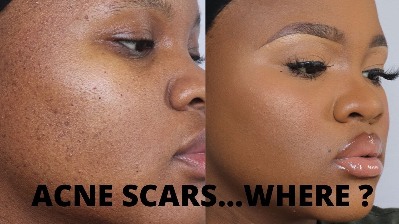 FLAWLESS DRUG STORE FOUNDATION WITH ACNE SCARS - YouTube
