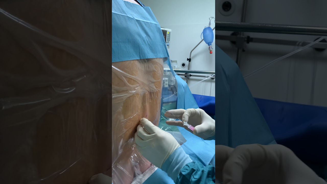 PDK lumbar L3/4 epidural mediale Punktion - YouTube