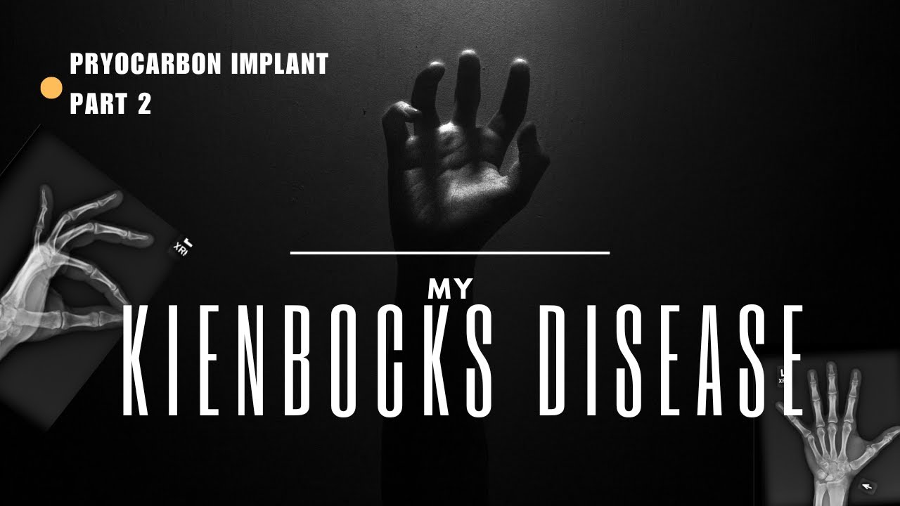 My Kienbocks Disease PART-2 Post-op Tenoarthroplasty (Pyrocarbon Lunate ...