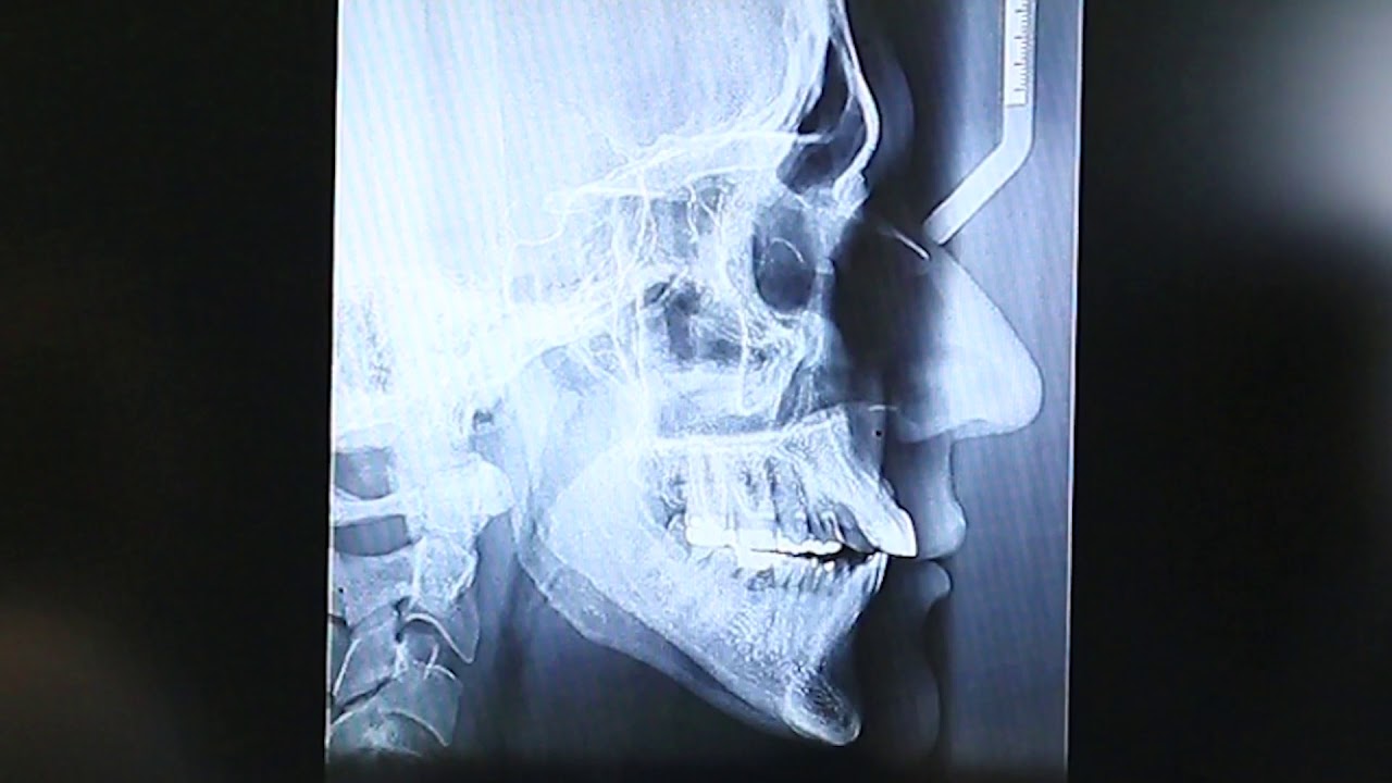 O tipo facial, meso, braqui e dolico - Uma característica importante ...