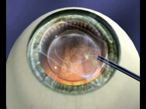 Visian ICL Surgical Technique Animation - YouTube