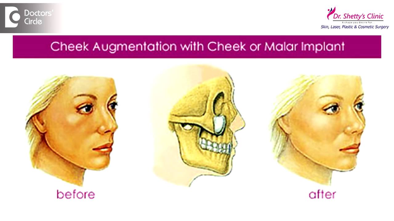 What is Cheek Augmentation and when is it indicated Dr Sahebgowda ...
