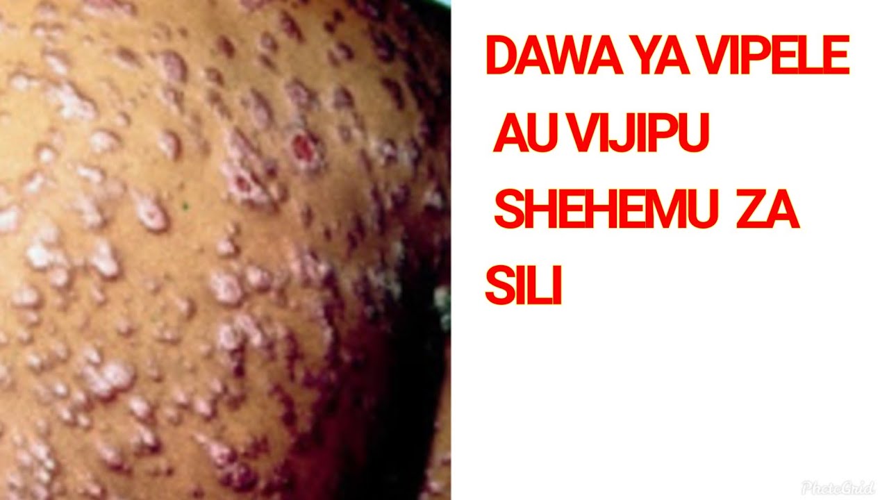 Jinsi ya kuondoa vipele au vijipu shehemu ya private - YouTube