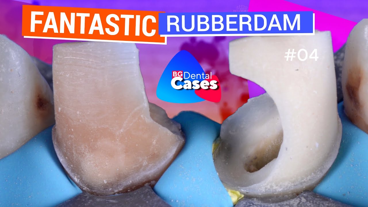 Fantastic rubberdam, preparation and endo. BG Dental Cases. #04 - YouTube