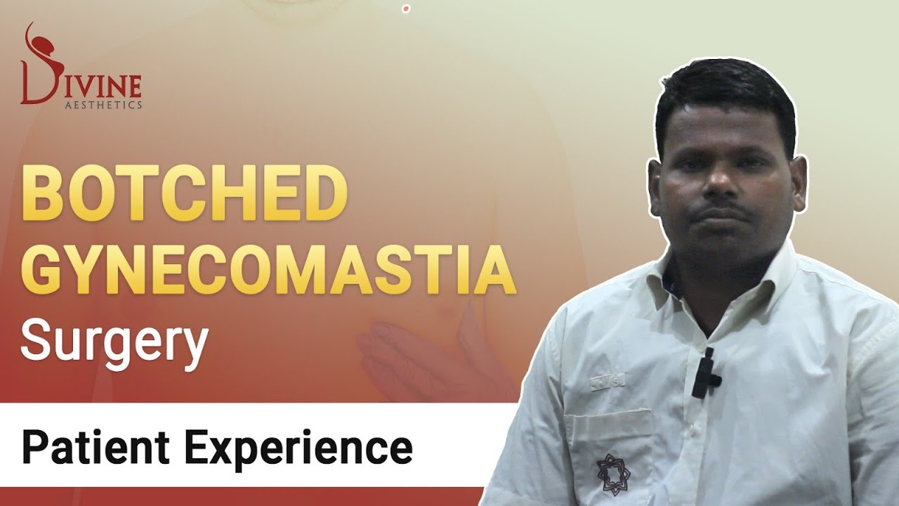 Botched Gynecomastia Surgery | Patient Experience | Dr. Amit Gupta l ...