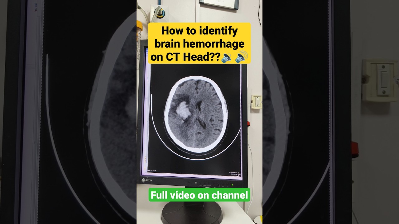 how to read CT scan of brain #brainhemorrhage #brainstroke #ctscan # ...