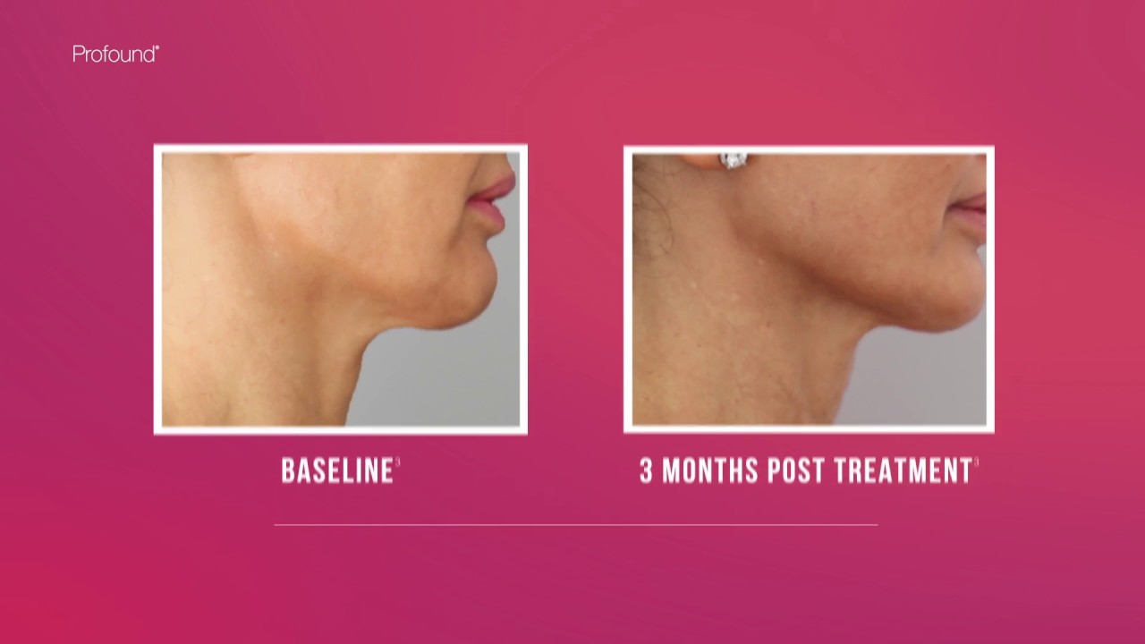 Profound by Candela - YouTube