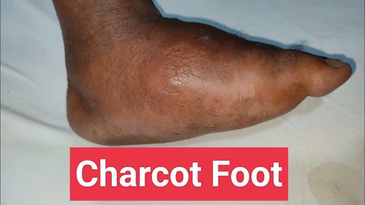 Understanding Charcot Foot in Diabetes: Symptoms, Treatment, and Care ...