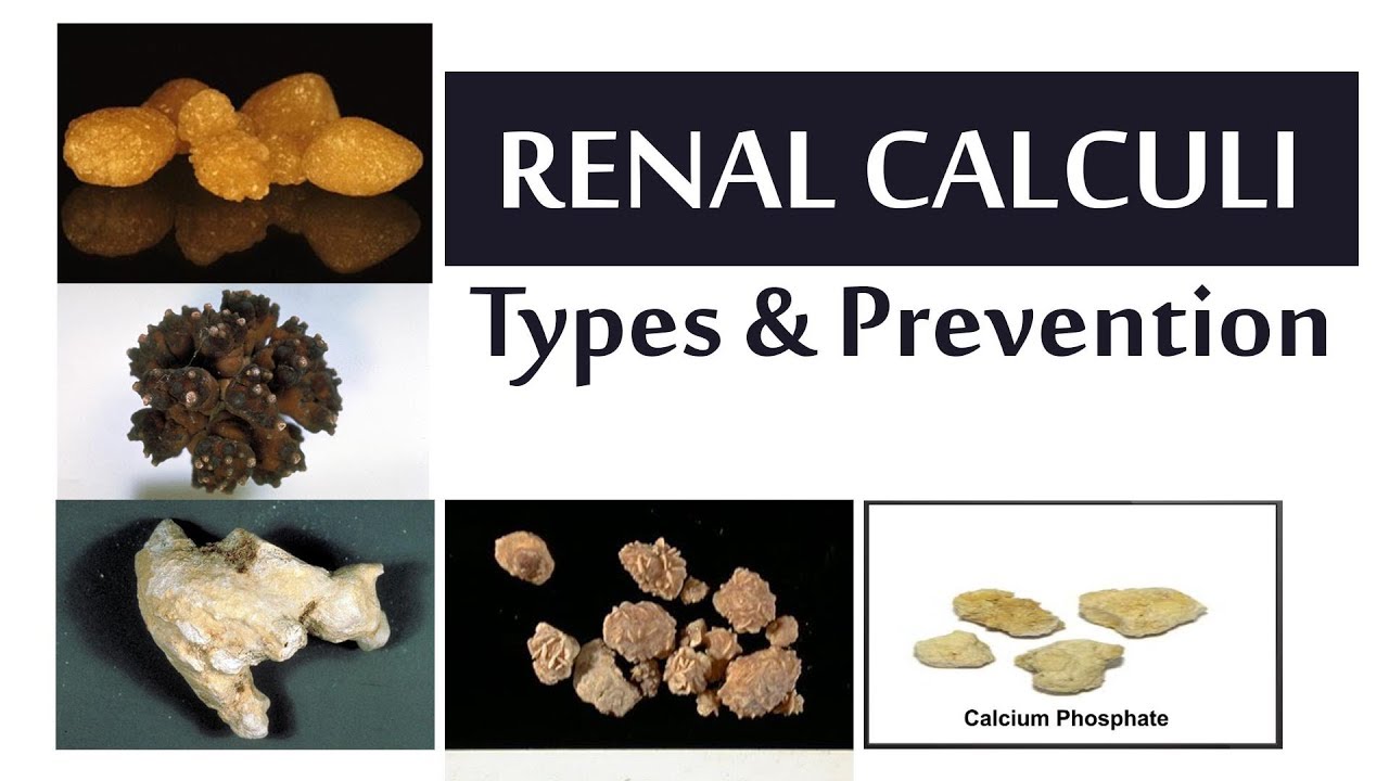 Renal Calculi Types And Prevention YouTube