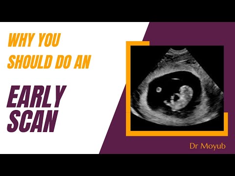 Why pregnant women should do an early scan. - YouTube