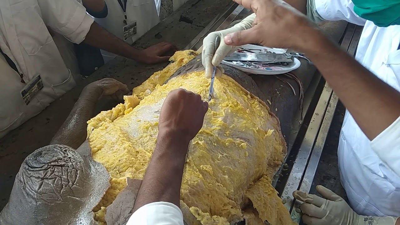 Anatomical dissectiom of dead body ...during removal of deep fascia ...