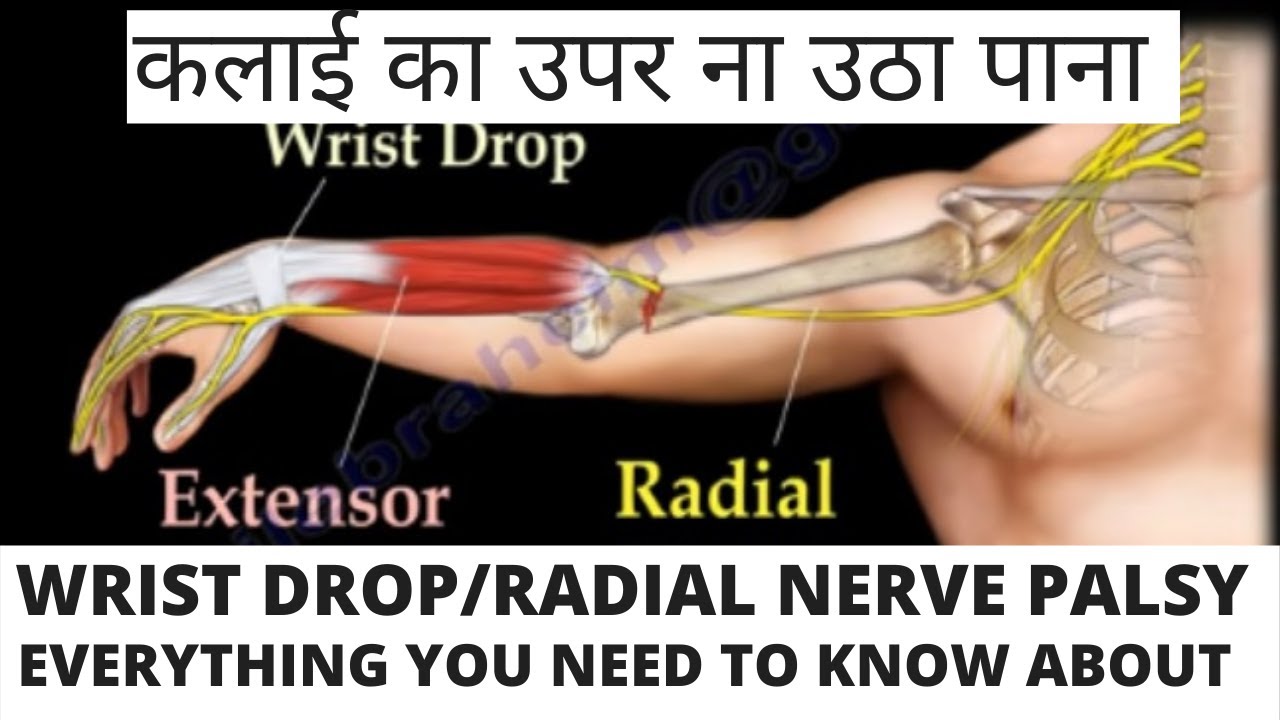 WRIST DROP PHYSIOTHERAPY | RADIAL NERVE PALSY| कलाई का उपर ना उठा पाना ...