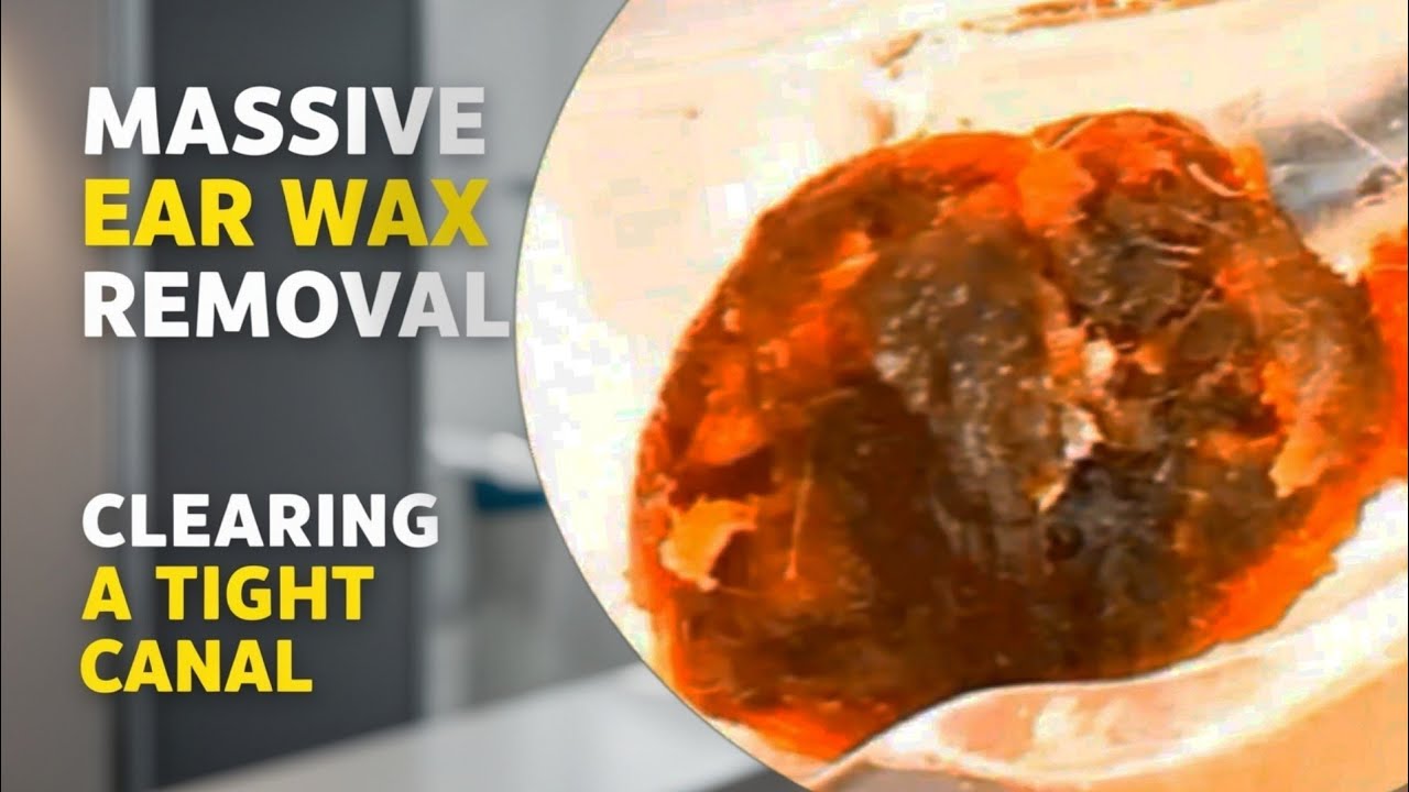 Clearing a Tight Ear Canal of Massive Ear Wax - YouTube