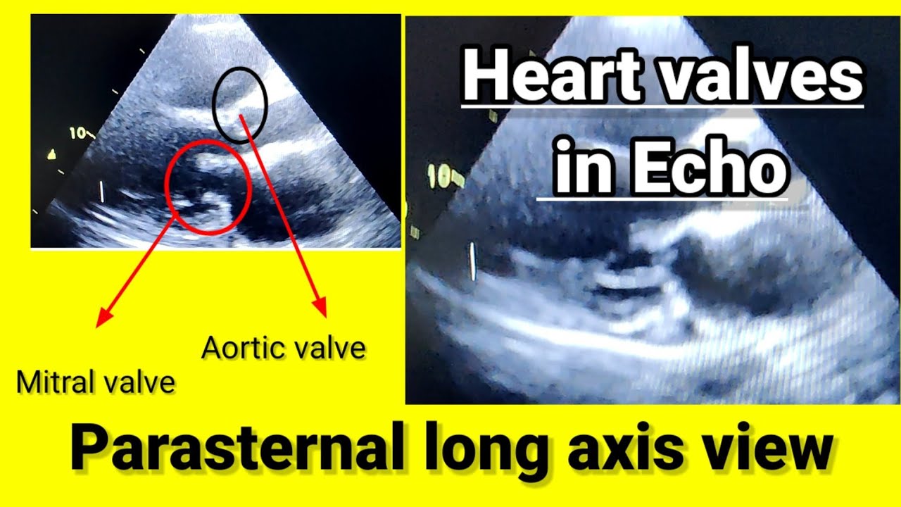 Heart valves in Echocardiography, normal morphology of valves, Types of ...