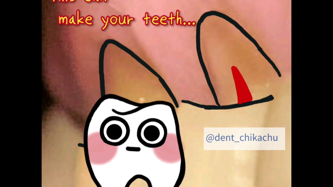 fractured teeth!! Tooth Cervical Abfraction - YouTube