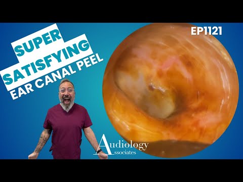 What Is Ear Wax Extraction