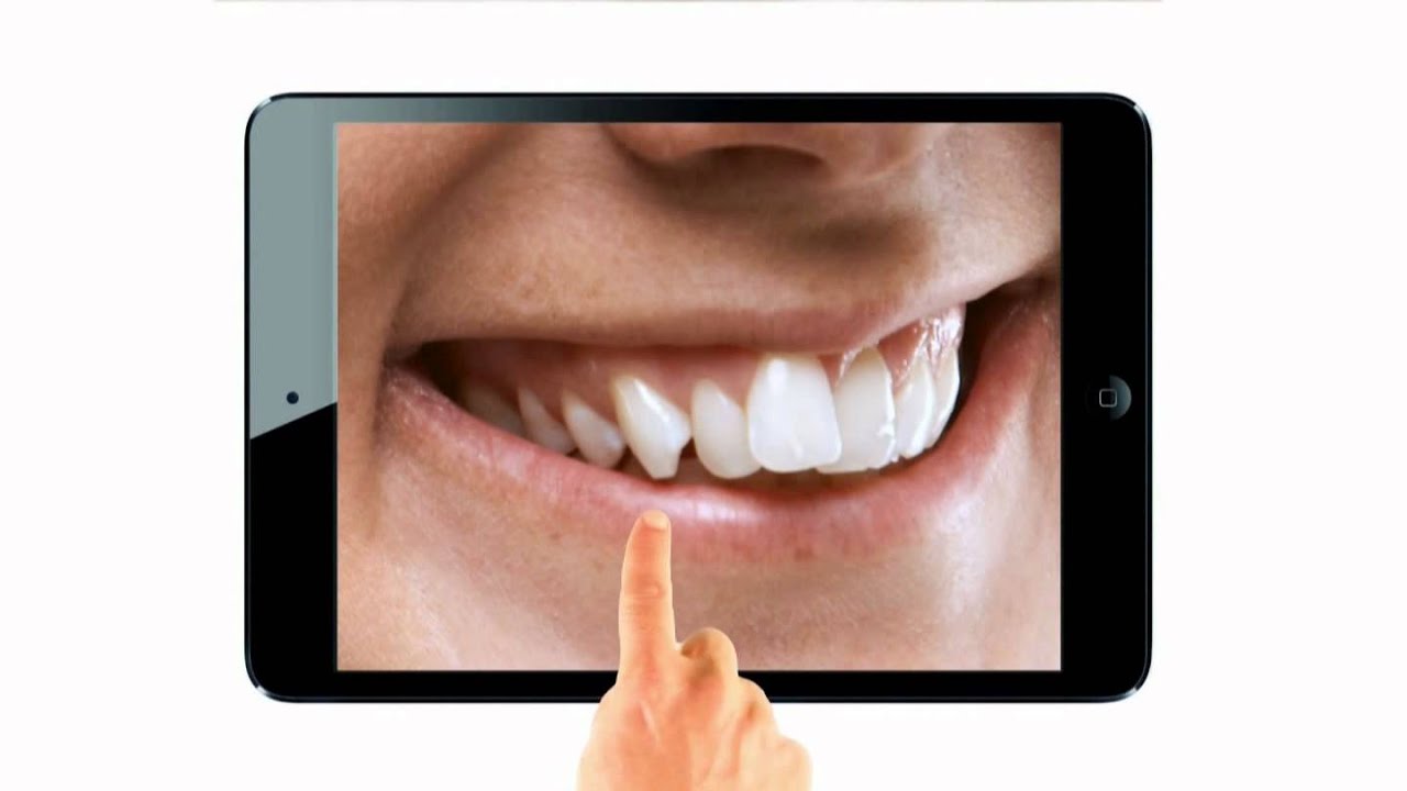 Six Month Smiles- What is it? How does it work? Who is a candidate ...