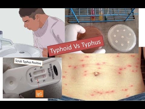 Typhoid vs typhus fever - YouTube