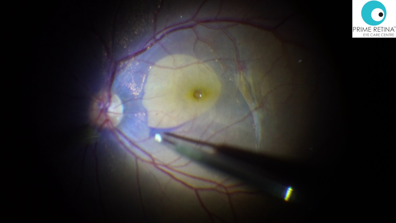 Macular hole - ILM PEELING surgery in 4K resolution- Dr.Sandeep Bachu ...