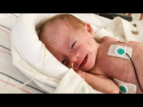 Born 2 months early with Down syndrome, tiny baby beats the odds