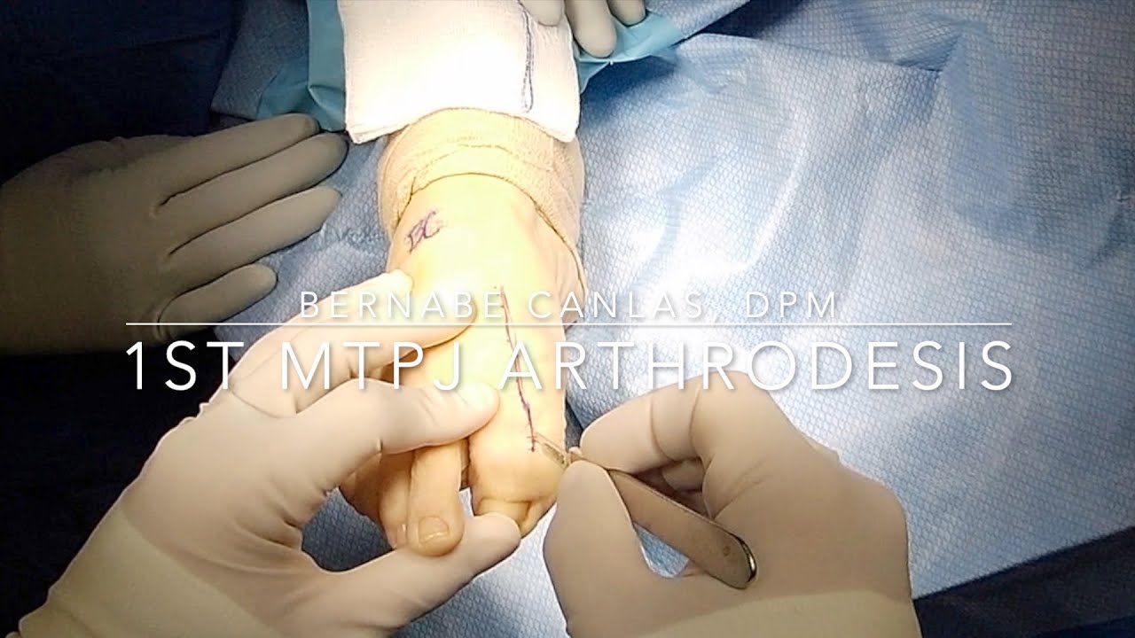 1st MTPJ Arthrodesis - YouTube