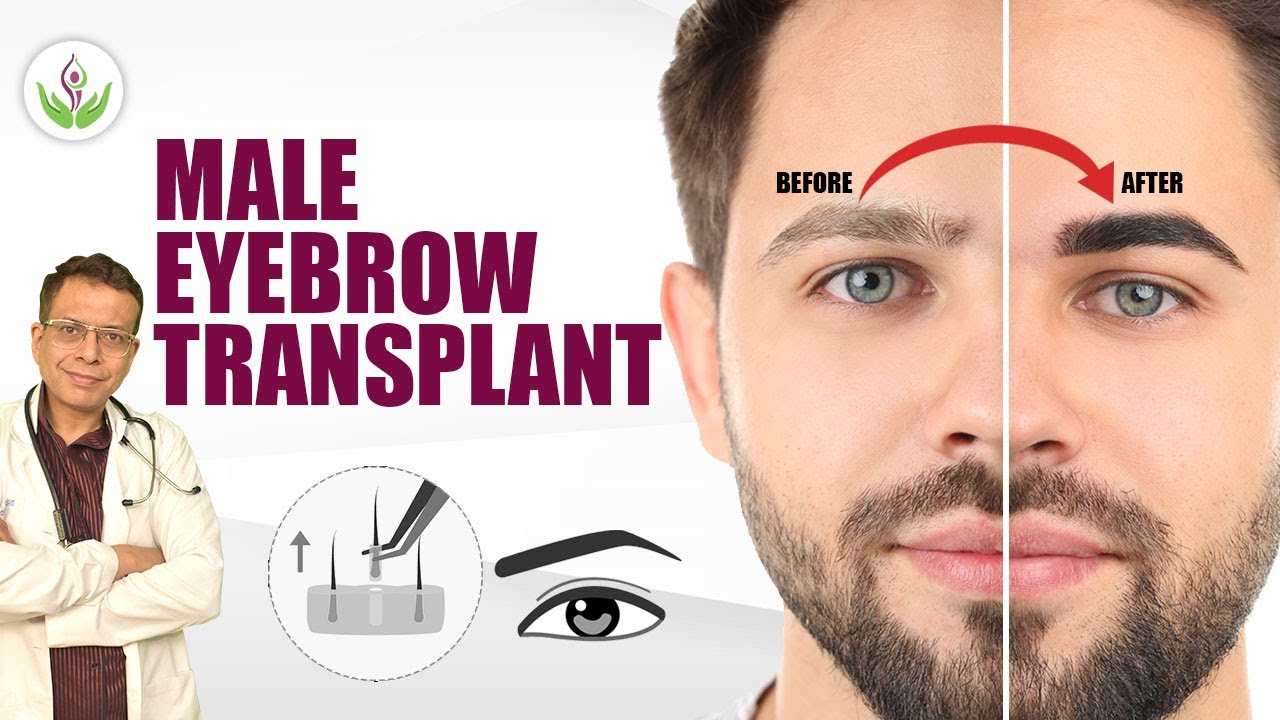 Male Eyebrow Transplant (आईब्रो ट्रांसप्लांट) Procedure in Delhi | Care ...