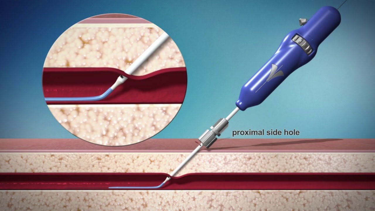 VascuClose XP - vascular closure device demonstration - YouTube
