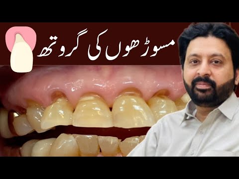 How To Easily REGROW Receding Gums to FIX Gum Recession At Home - YouTube