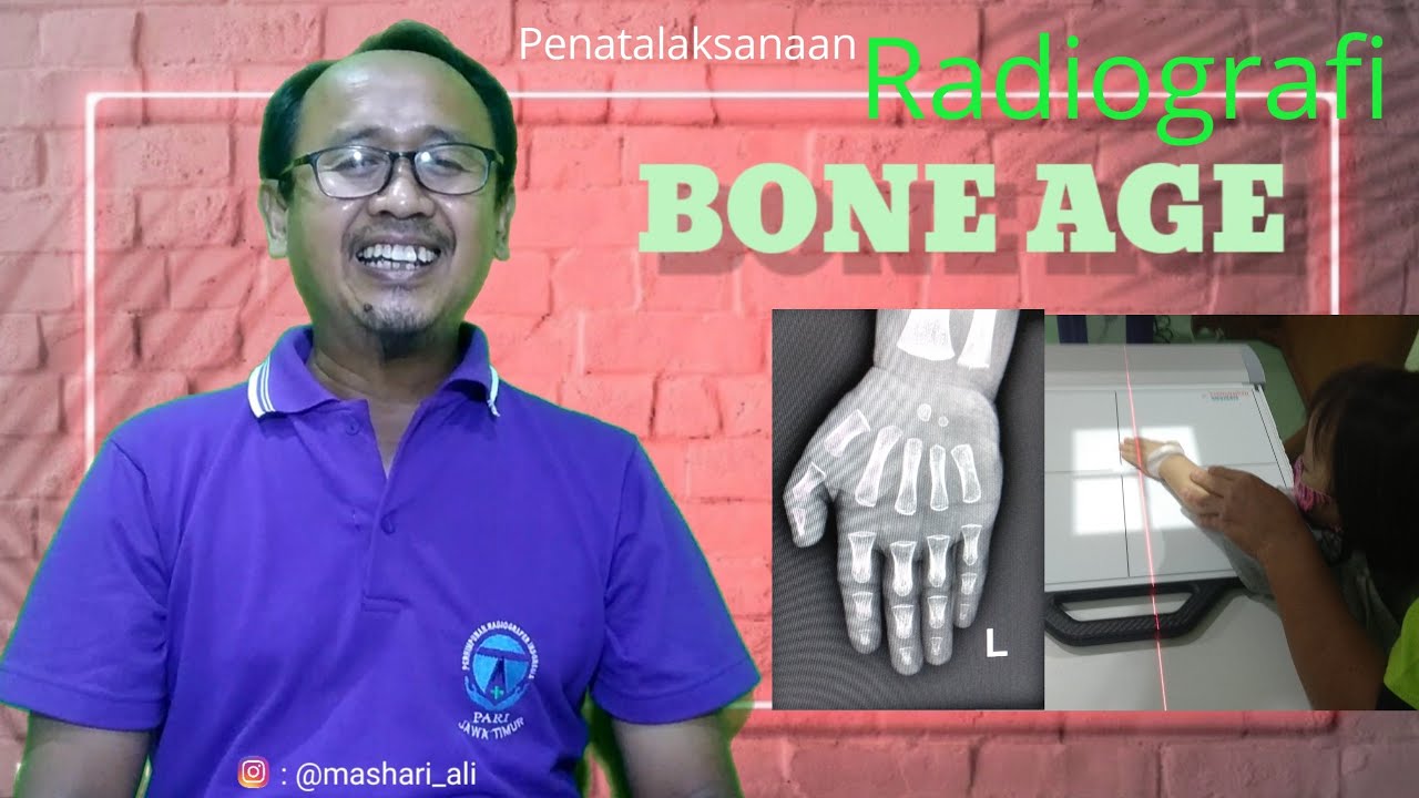 78. Radiografi Bone Age - YouTube